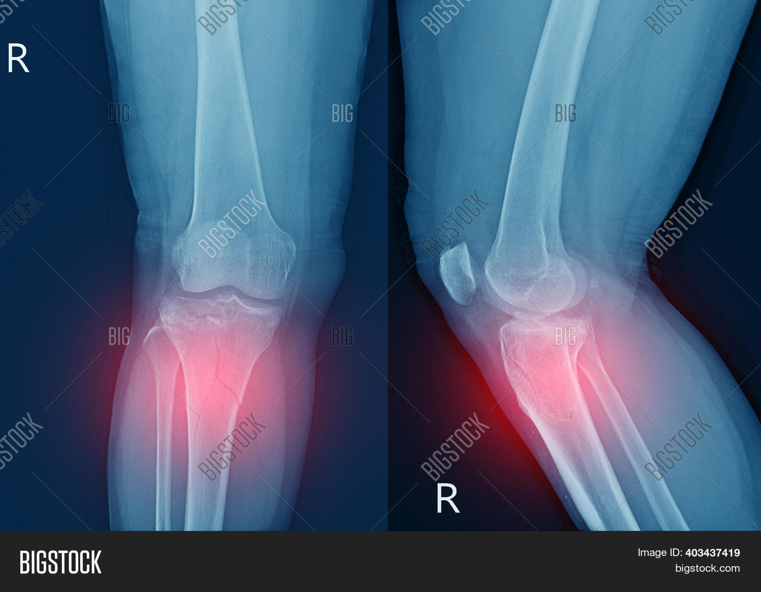 X-ray Knee Fracture Image & Photo (Free Trial) | Bigstock