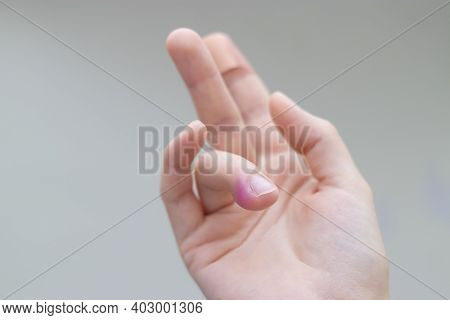 Abscess On Finger. Image & Photo (Free Trial) | Bigstock