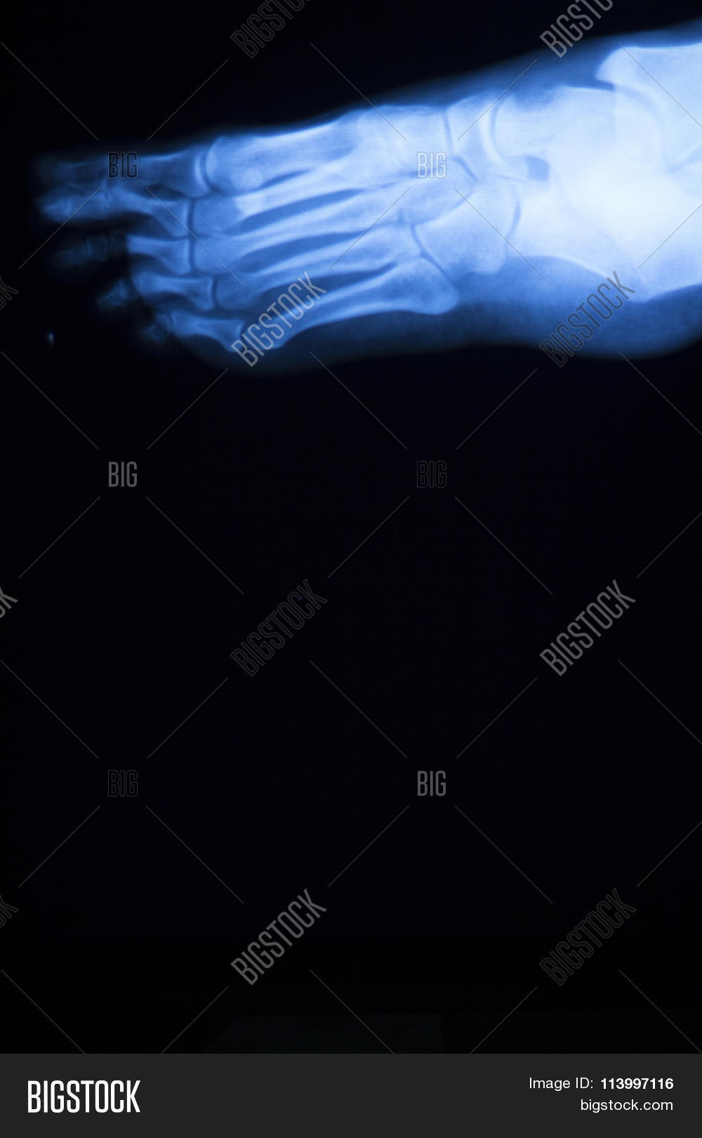 Foot Toes Injury X-ray Image & Photo (Free Trial) | Bigstock