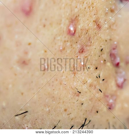 Acne Inflammation. Image & Photo (Free Trial) | Bigstock