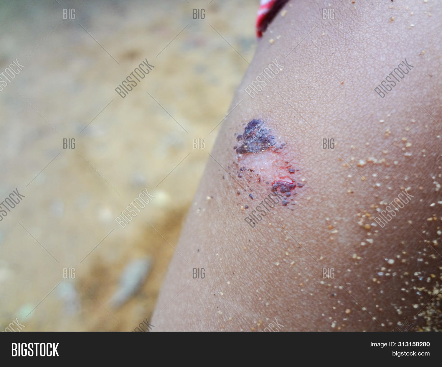 Wound On Elbow Child Image & Photo (Free Trial) | Bigstock