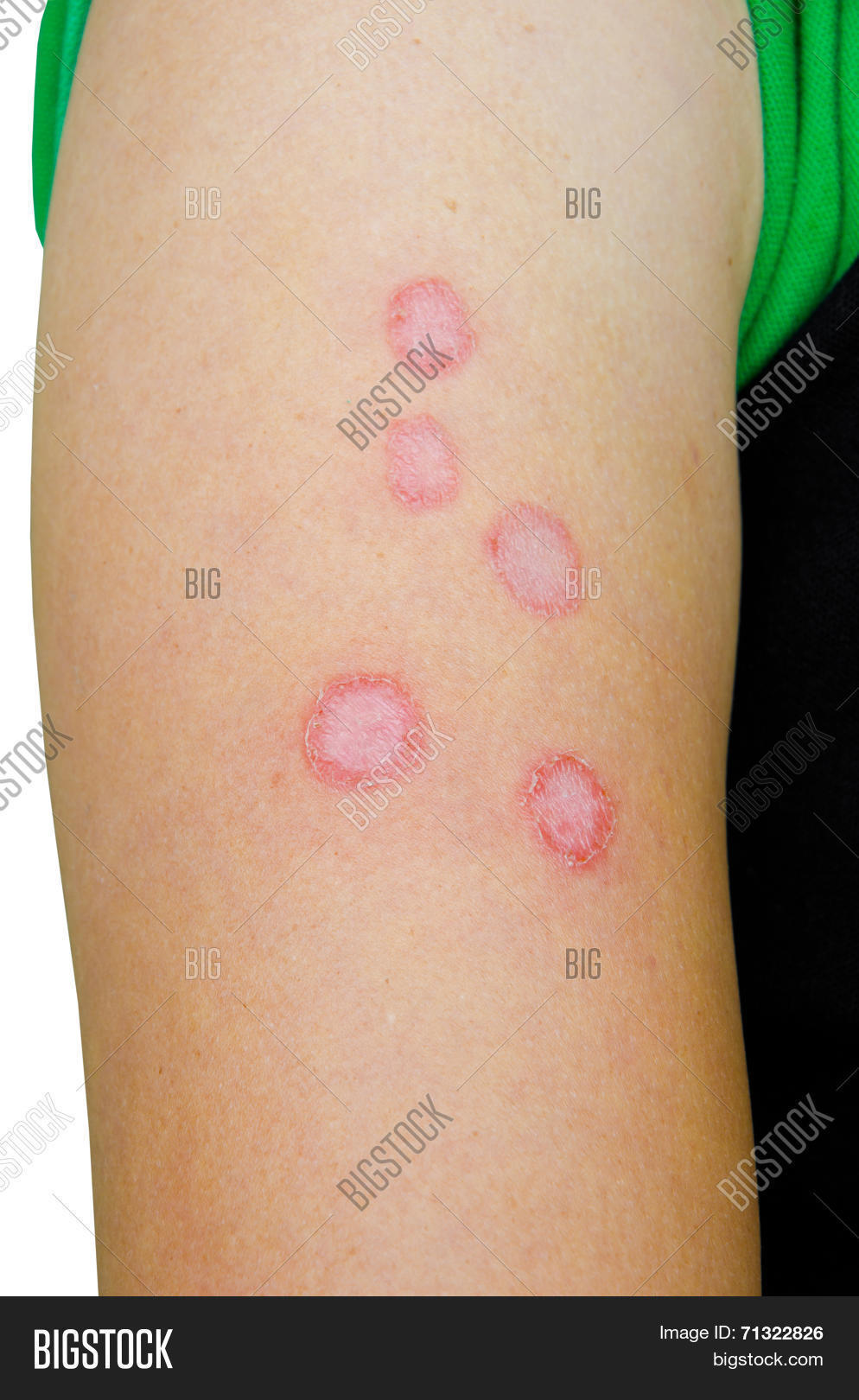 Microsporia Fungus On Image & Photo (Free Trial) | Bigstock