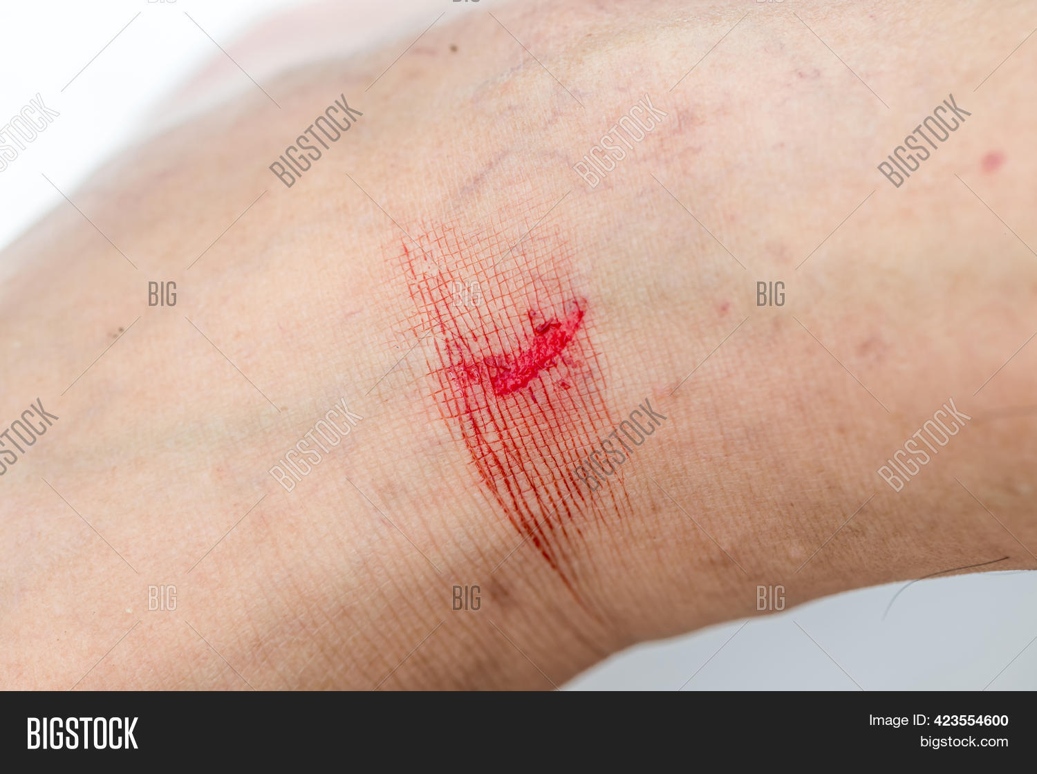 Injuries Falling Image & Photo (Free Trial) | Bigstock