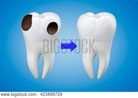 Carious Tooth Image & Photo (Free Trial) | Bigstock