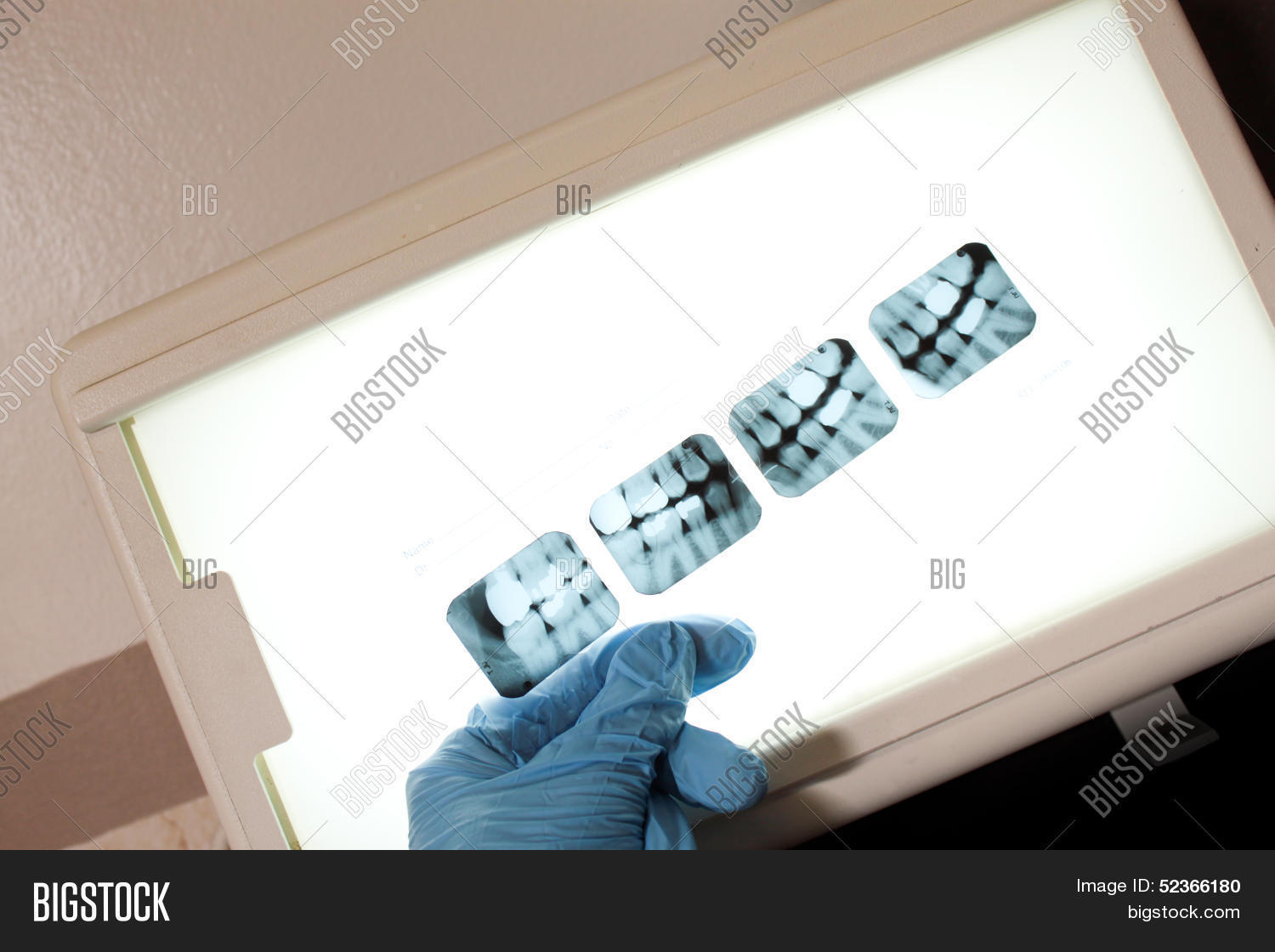 Dental Bitewing X-rays Image & Photo (Free Trial) | Bigstock