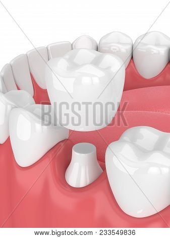 3D Render Jaw Teeth Image & Photo (Free Trial) | Bigstock