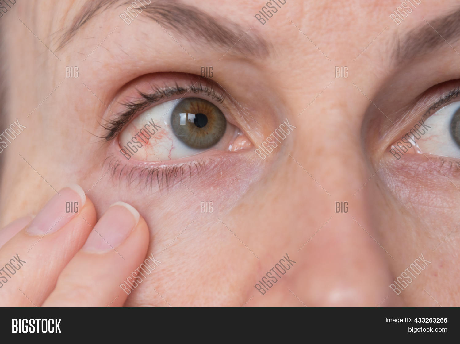 Reddened Eye. Inflamed Image & Photo (Free Trial) | Bigstock
