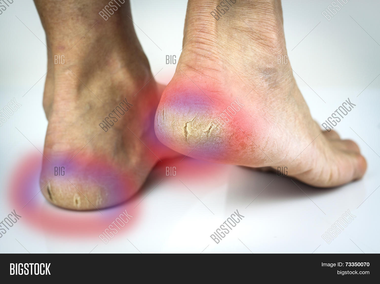 Cracked Heels On White Image & Photo (Free Trial) | Bigstock