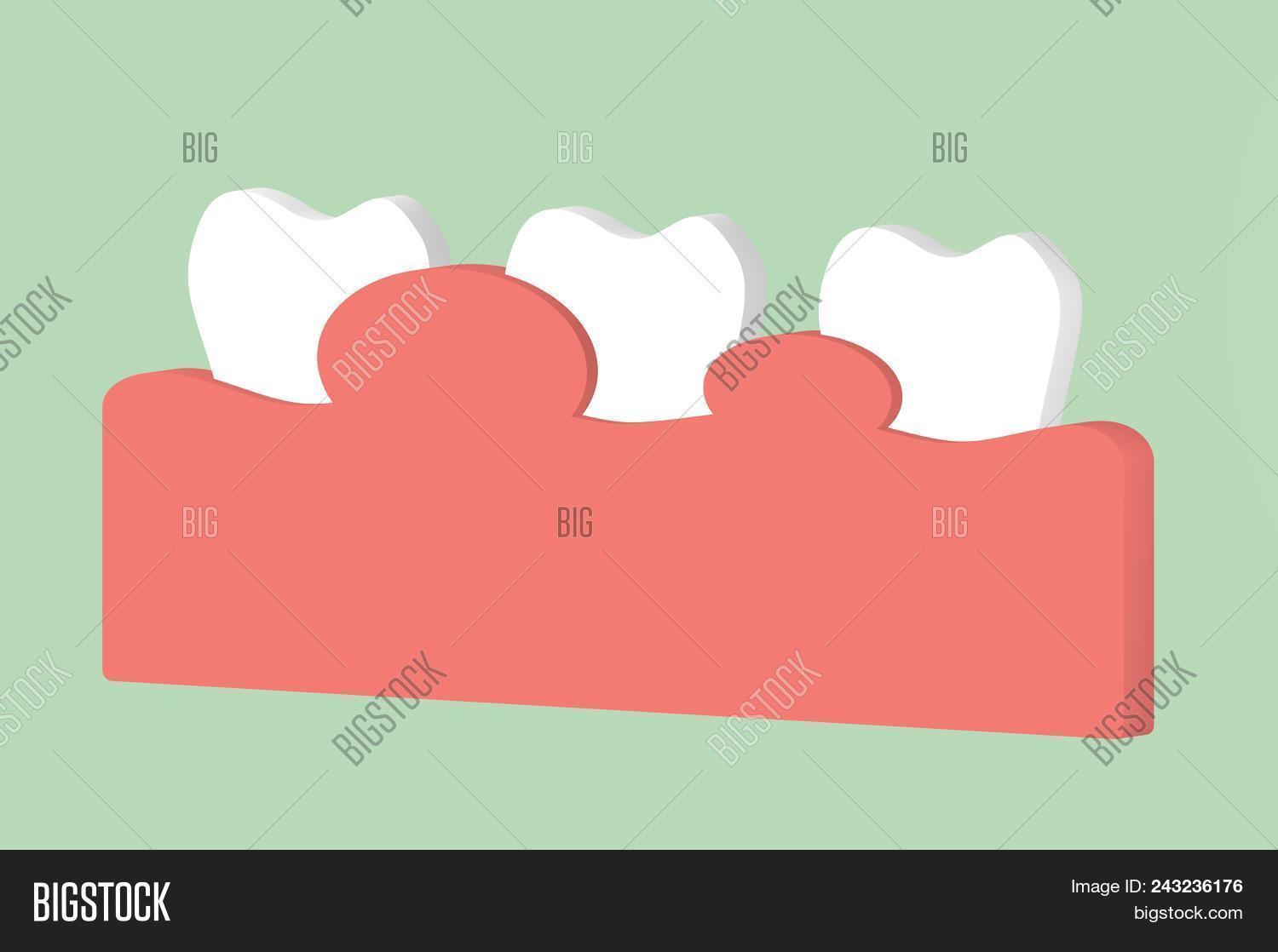 Gingivitis Periodontal Image & Photo (Free Trial) | Bigstock