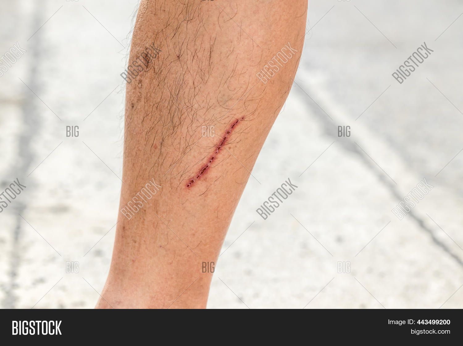 Close Scar On Skin. Image & Photo (Free Trial) | Bigstock