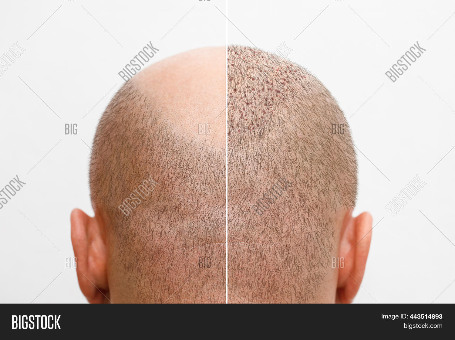 Head Balding Man Image & Photo (Free Trial) | Bigstock