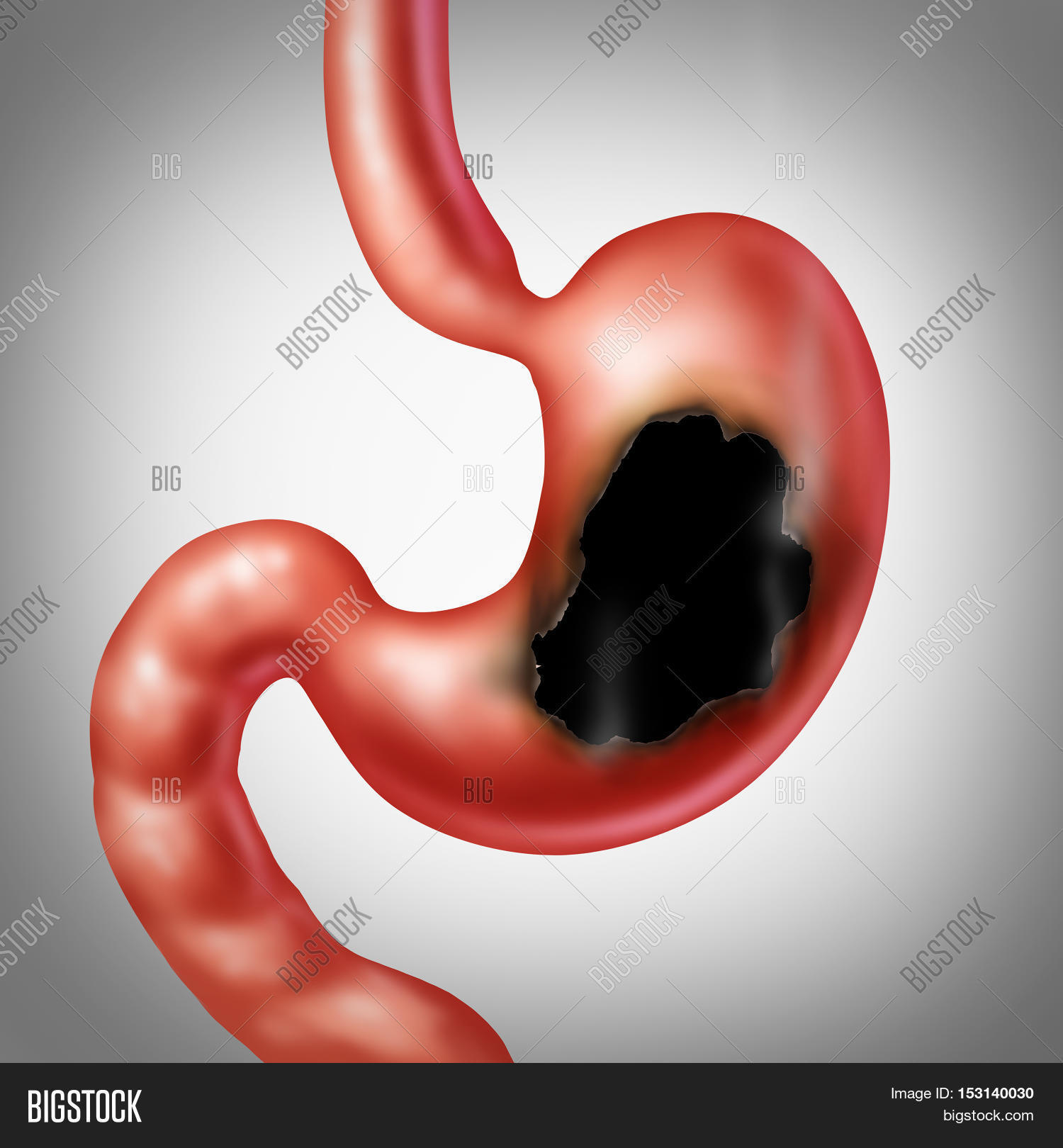 Stomach Ulcer Medical Image & Photo (Free Trial) | Bigstock