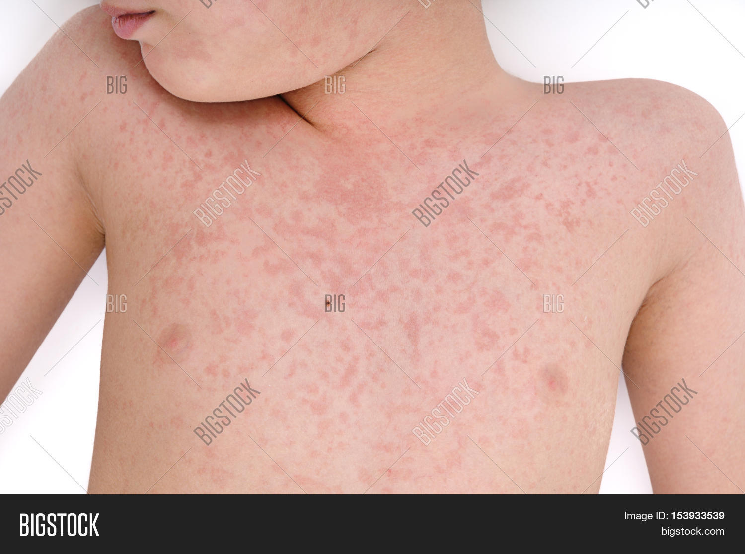 Allergic Reaction Image & Photo (Free Trial) | Bigstock