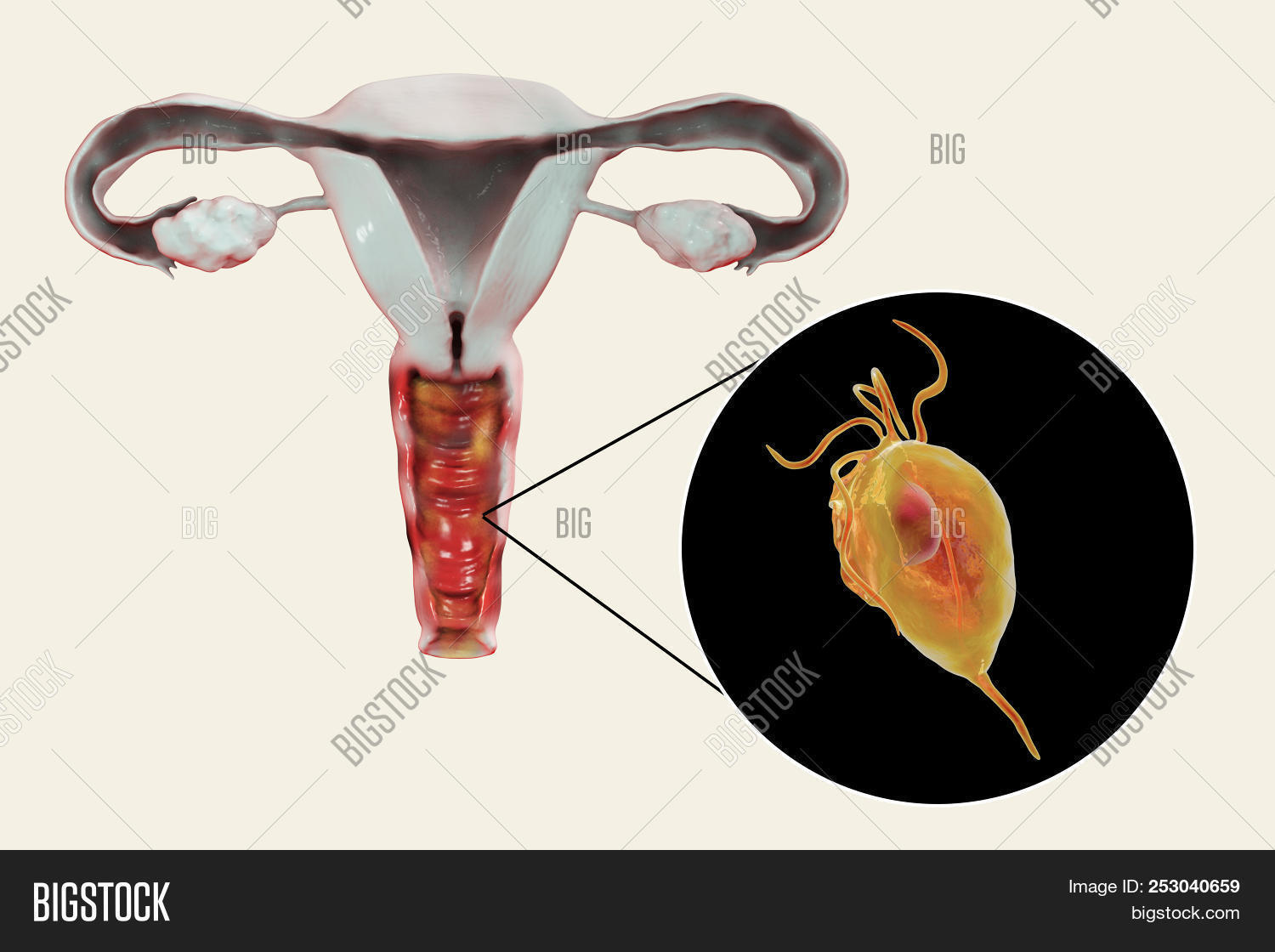 Female Trichomoniasis Image & Photo (Free Trial) | Bigstock