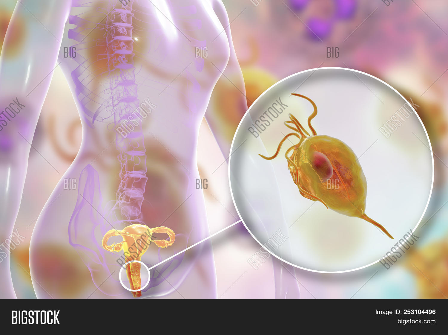 Female Trichomoniasis Image & Photo (Free Trial) | Bigstock