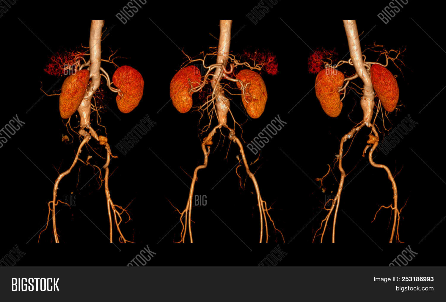 Cta Abdominal Aorta Image & Photo (Free Trial) | Bigstock