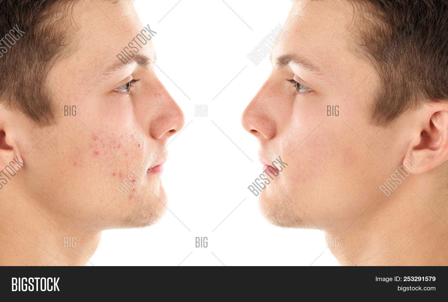 Young Man Acne Problem Image & Photo (Free Trial) | Bigstock