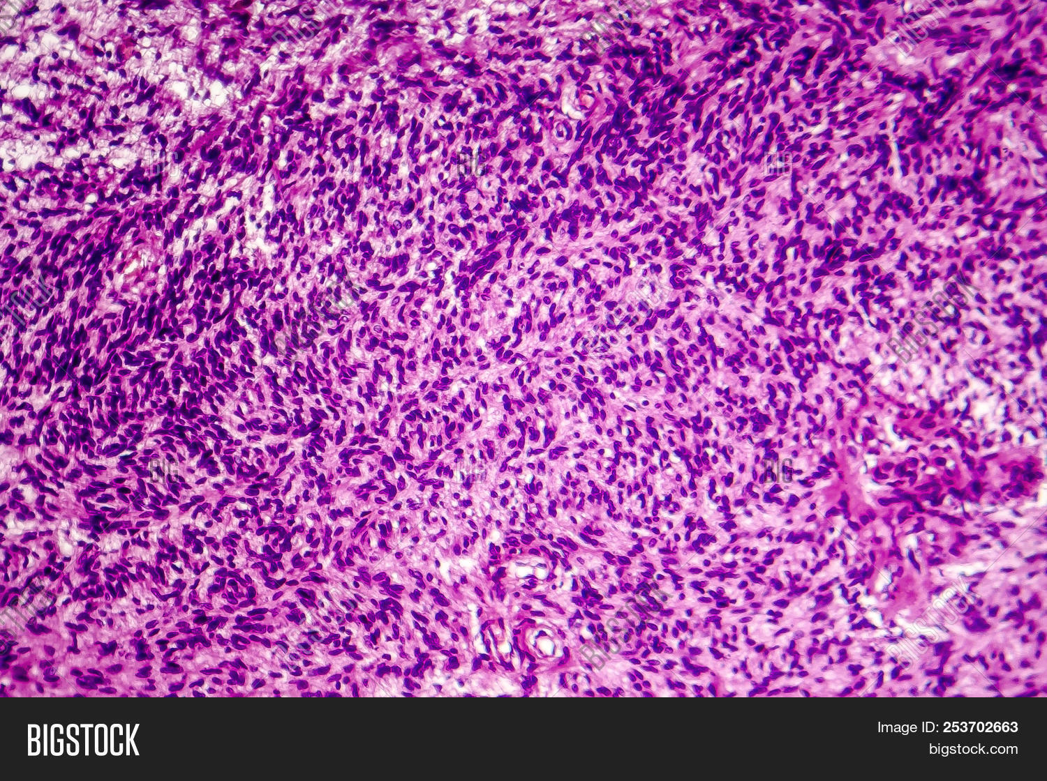 Fibrosarcoma, Image & Photo (Free Trial) | Bigstock