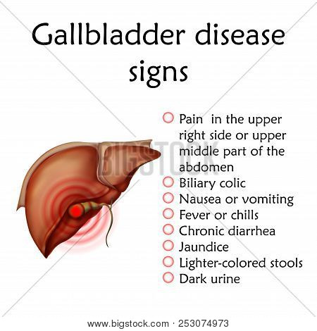 Gallbladder Disease Vector & Photo (Free Trial) | Bigstock