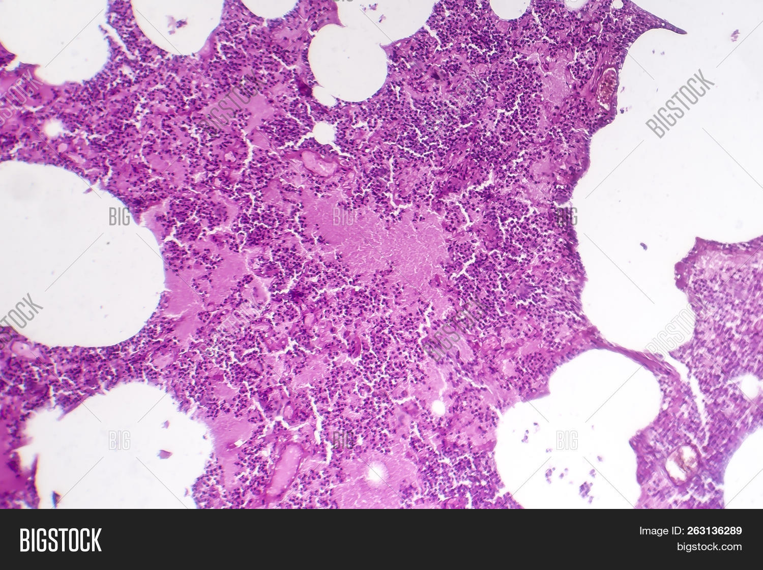 Lobar Pneumonia, Image & Photo (Free Trial) | Bigstock