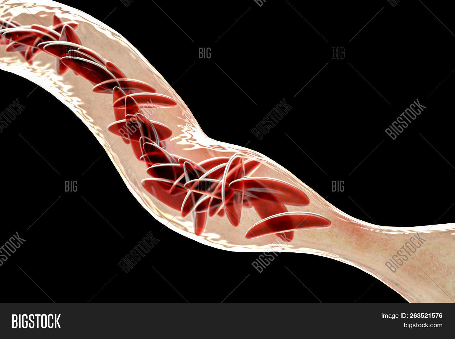 Sickle Cell Anemia, 3d Image & Photo (Free Trial) | Bigstock