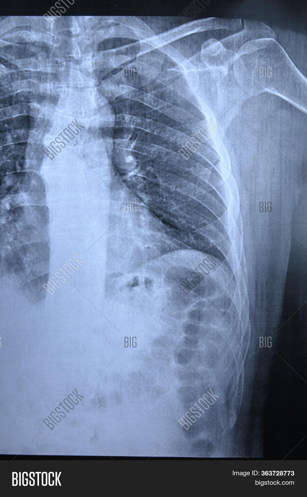 X-ray Lungs Sick Image & Photo (Free Trial) | Bigstock