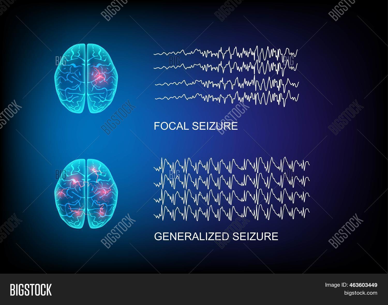 Illustration Seizure Image & Photo (Free Trial) | Bigstock