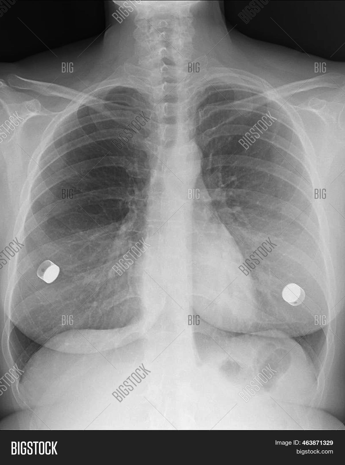 Chest X-ray Woman Image & Photo (Free Trial) | Bigstock