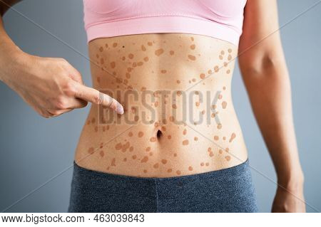 Woman Body Skin Rash Image & Photo (Free Trial) | Bigstock