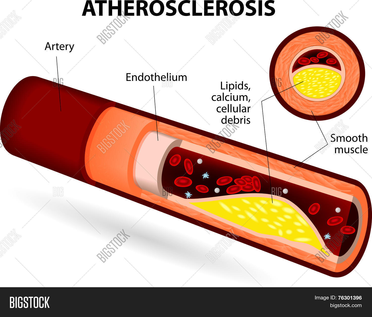 Atherosclerosis Vector & Photo (Free Trial) | Bigstock