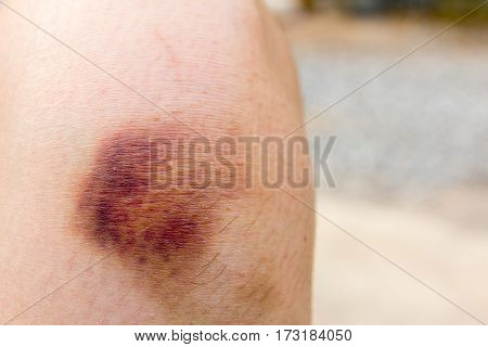 Brown Bruise Injury On Image & Photo (Free Trial) | Bigstock