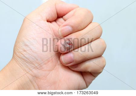 Fungal Nail Infection Image & Photo (Free Trial) | Bigstock