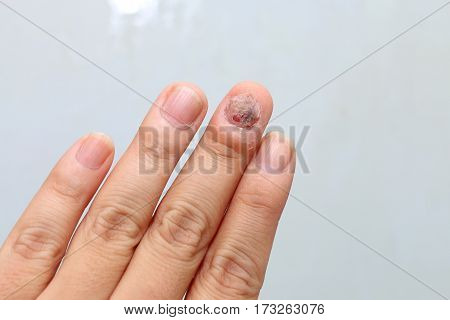 Fungal Nail Infection Image & Photo (Free Trial) | Bigstock