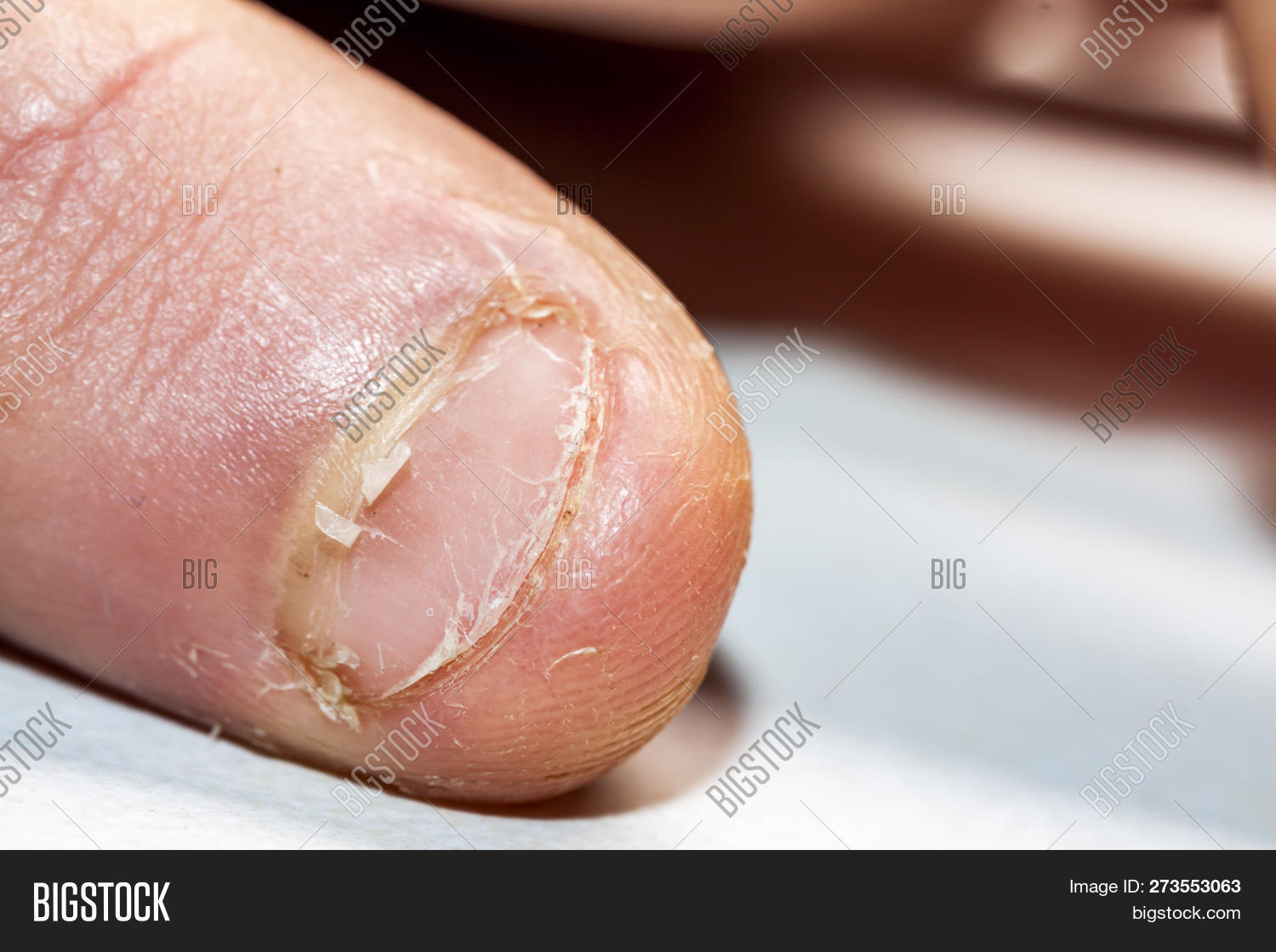 Close Hand Bitten Image & Photo (Free Trial) | Bigstock