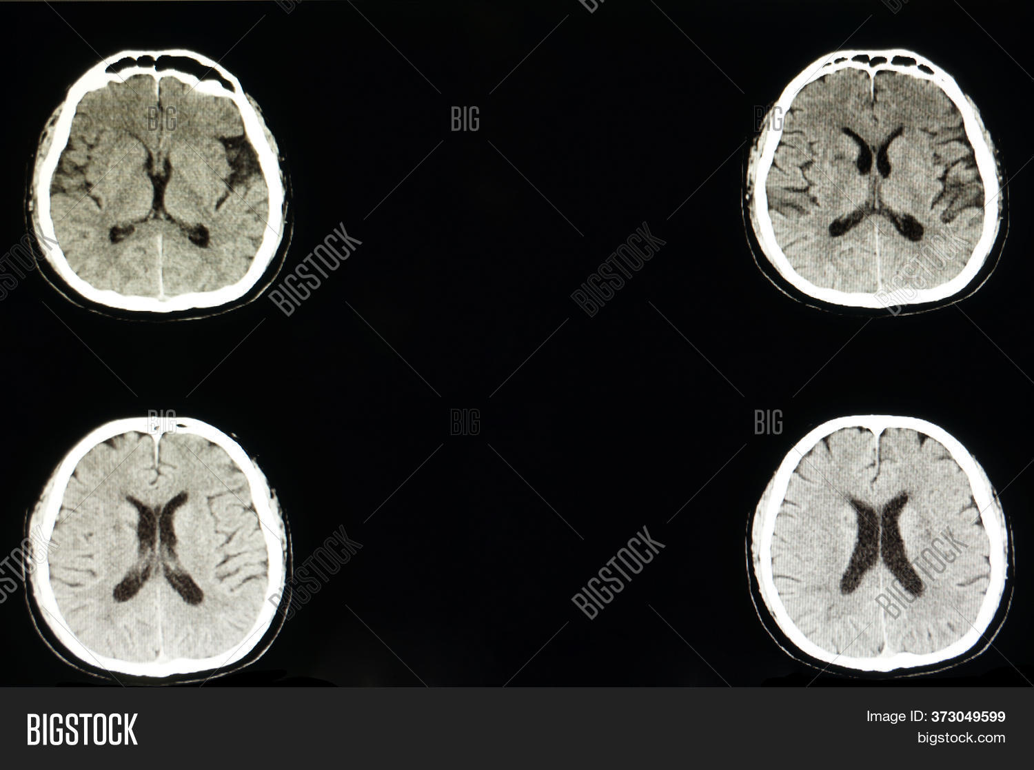 Ct Scan Brain Patient Image & Photo (Free Trial) | Bigstock