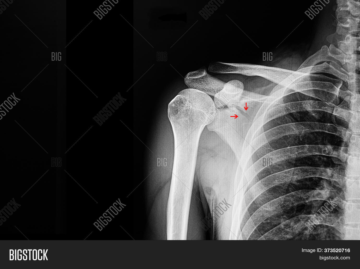 Shoulder Xray Film Image & Photo (Free Trial) | Bigstock