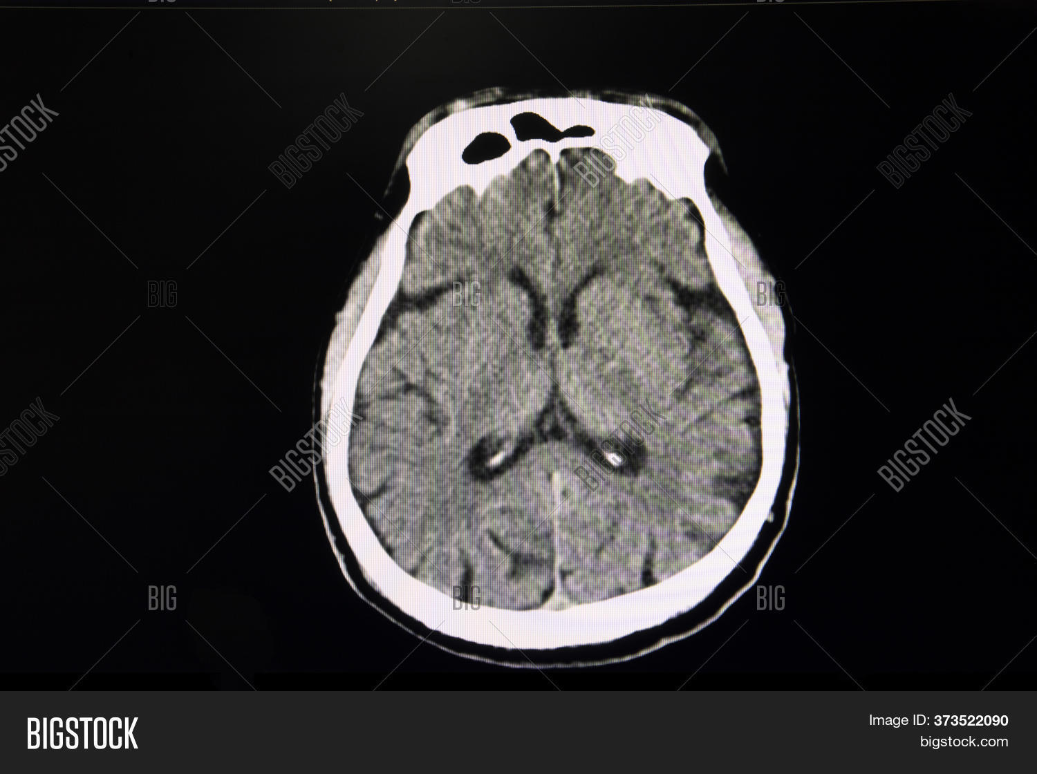 Ct Scan Brain Patient Image & Photo (Free Trial) | Bigstock