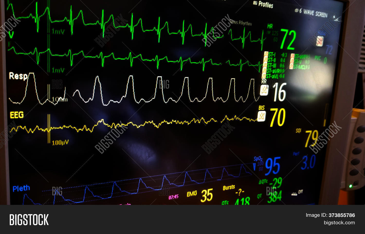 Ecg Monitor Screen