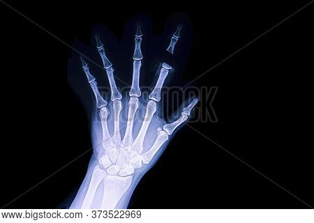 Hand X Ray Film Image & Photo (Free Trial) | Bigstock