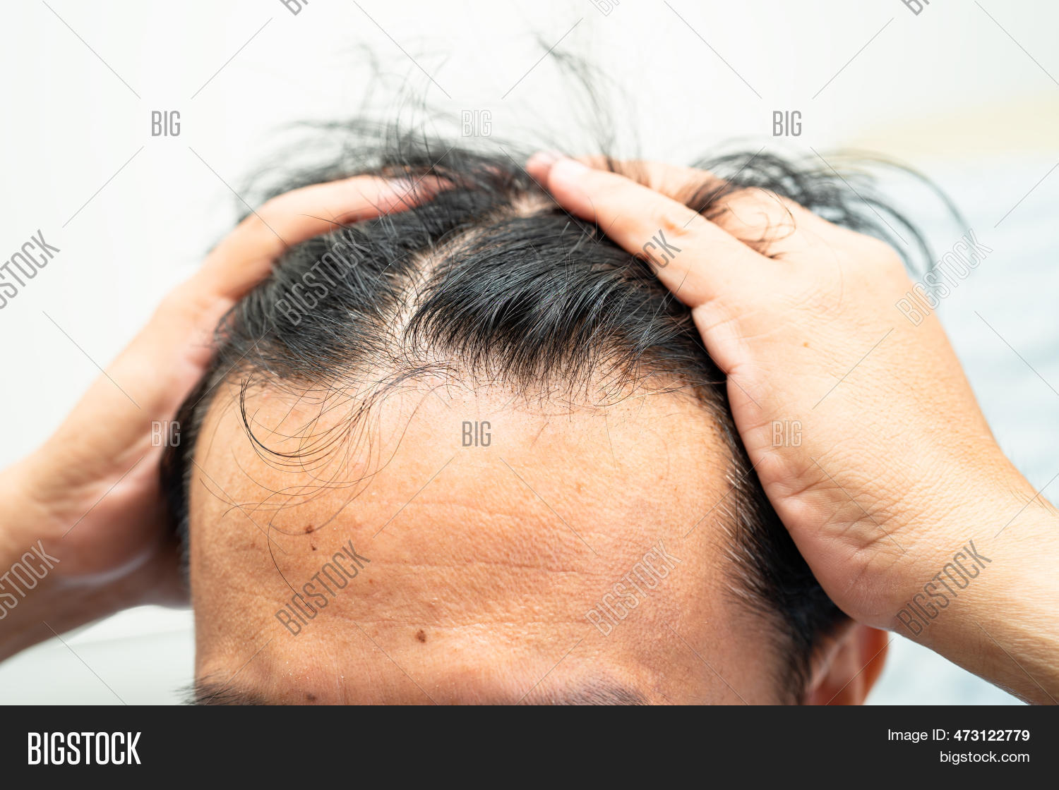 Bald Front Head Begin Image & Photo (Free Trial) | Bigstock