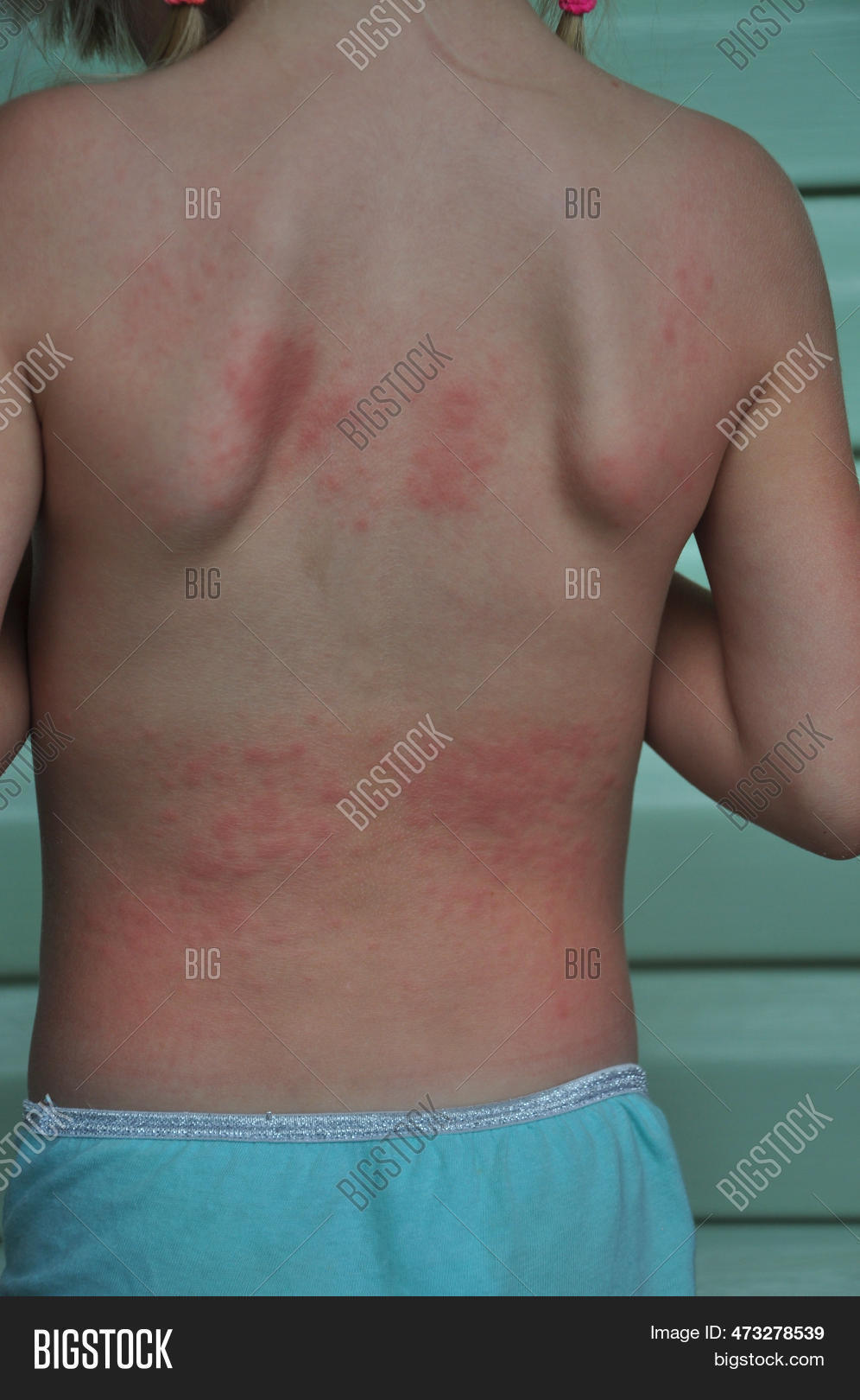 Back Child Urticaria. Image & Photo (Free Trial) | Bigstock