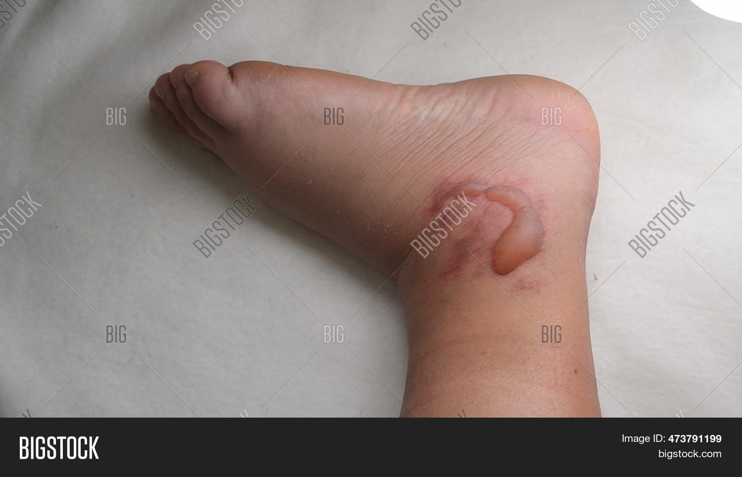 Swollen Leg Blisters Image & Photo (Free Trial) | Bigstock