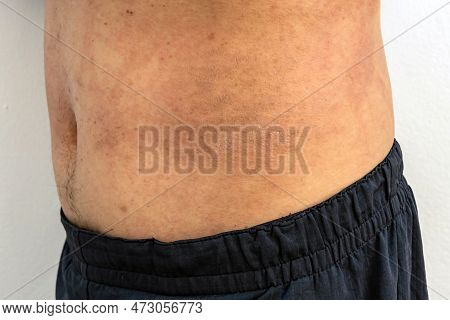 Itchy Body Rash Caused Image & Photo (Free Trial) | Bigstock