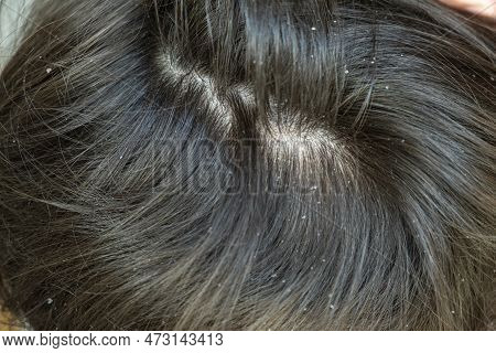 Dandruff Kid Hair. Image & Photo (Free Trial) | Bigstock