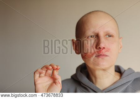 Hairless Cancer Sick Image & Photo (Free Trial) | Bigstock