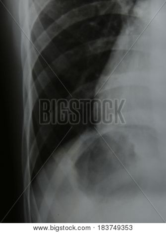 Close Chest X-ray Image & Photo (Free Trial) | Bigstock