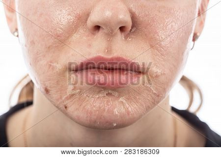 Female Face Burned Image & Photo (Free Trial) | Bigstock