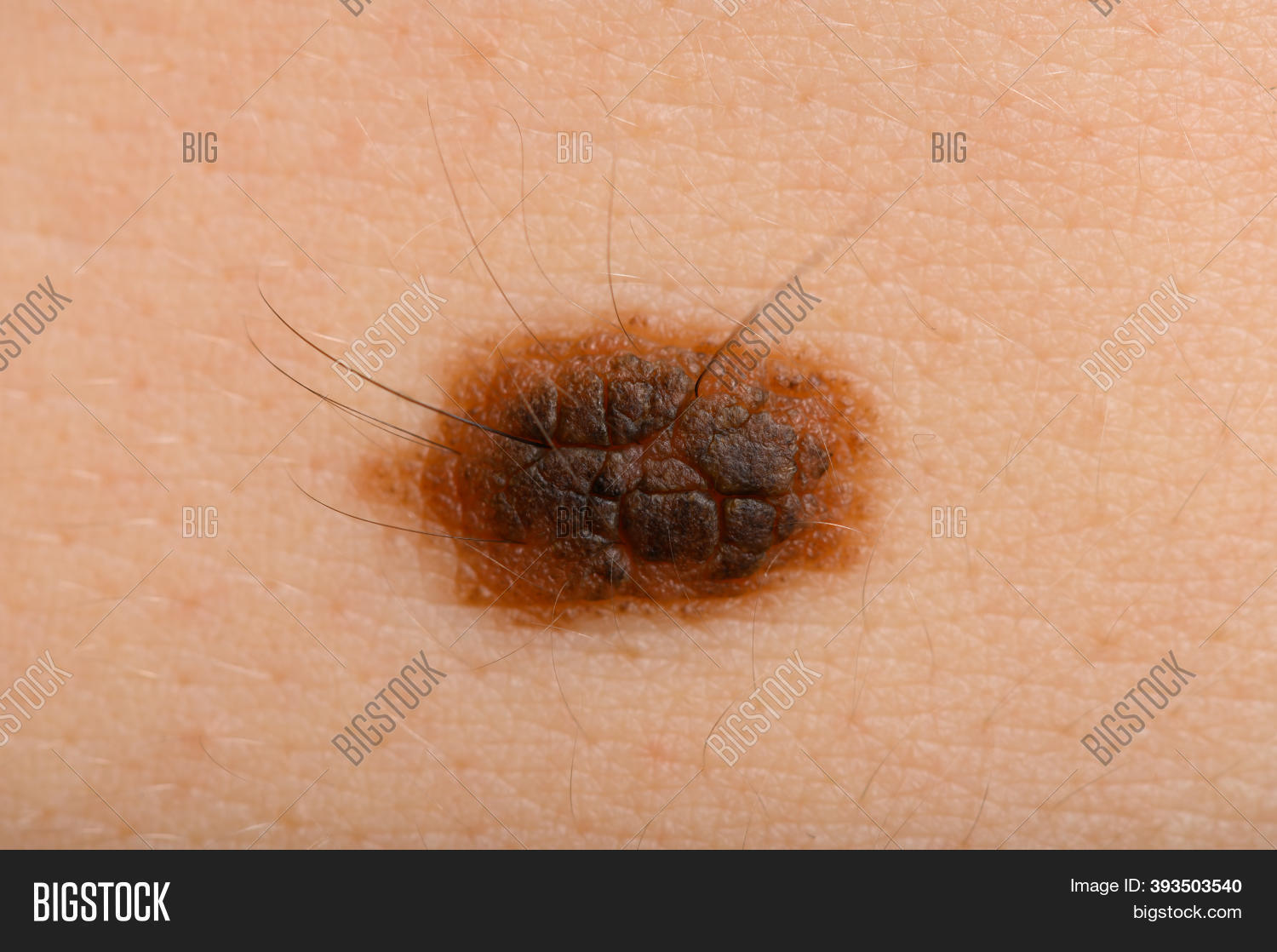 Large Nevus On Skin Image & Photo (Free Trial) | Bigstock