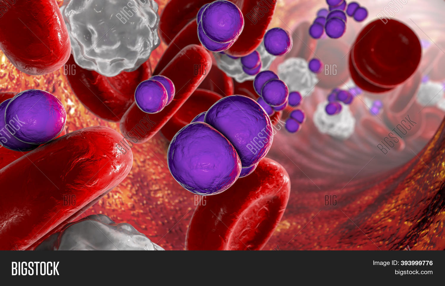 Meningococcemia, Image & Photo (Free Trial) | Bigstock