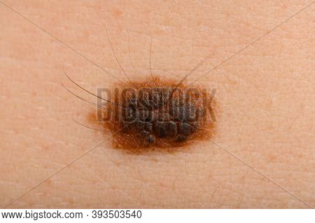Large Nevus On Skin Image & Photo (Free Trial) | Bigstock